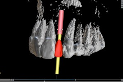 CT Scan Guided Implants | CT Scan Guided Implants - Kazemi Oral Surgery ...