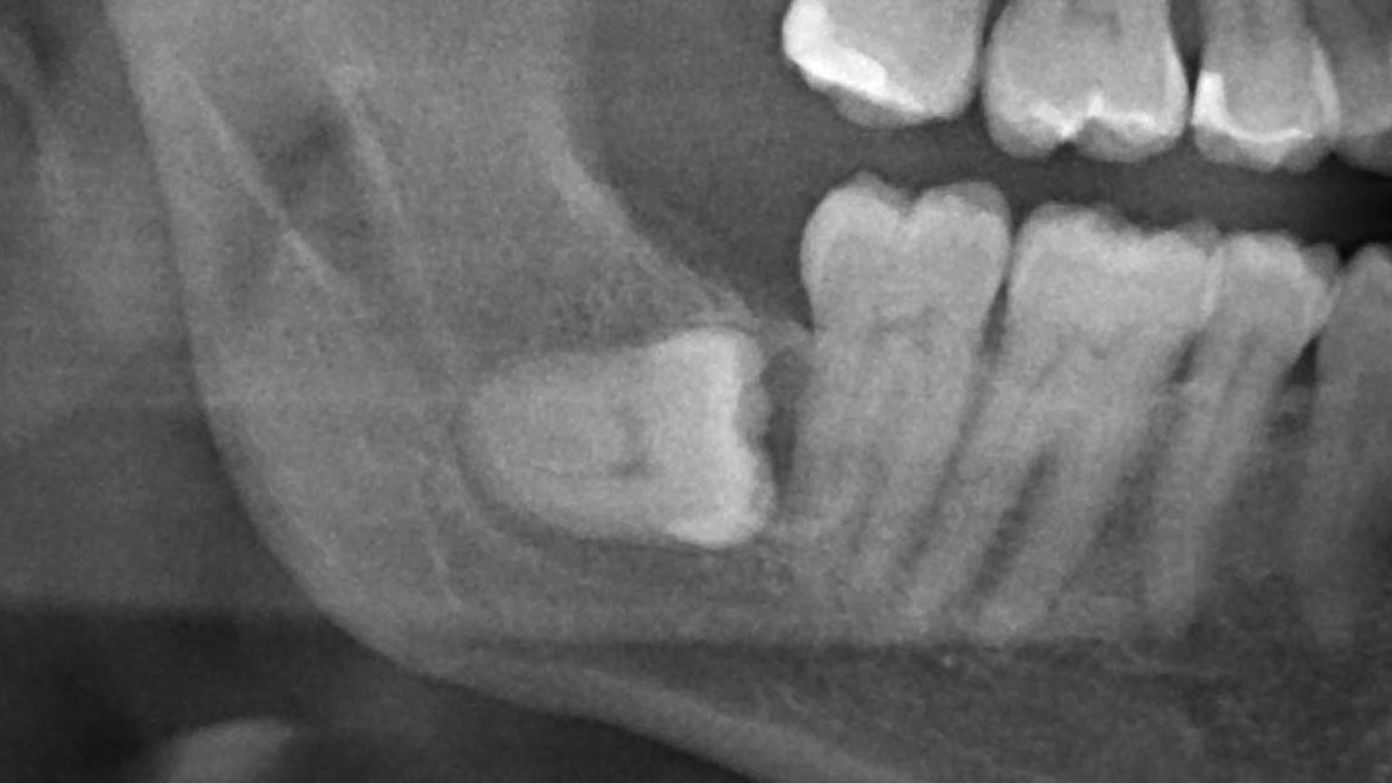 Odontogenic Dentigerous Tooth Cyst Impacted Wisdom Tooth Coronectomy Odontogenic Dentigerous Tooth Cyst Impacted Wisdom Tooth Coronectomy