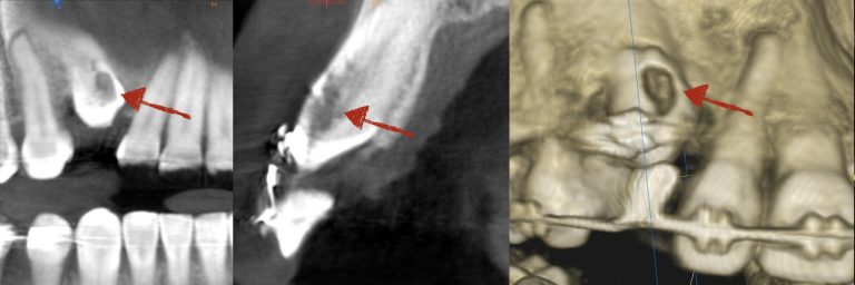 When Impacted Canines Do Not Move in Response to Exposure and ...