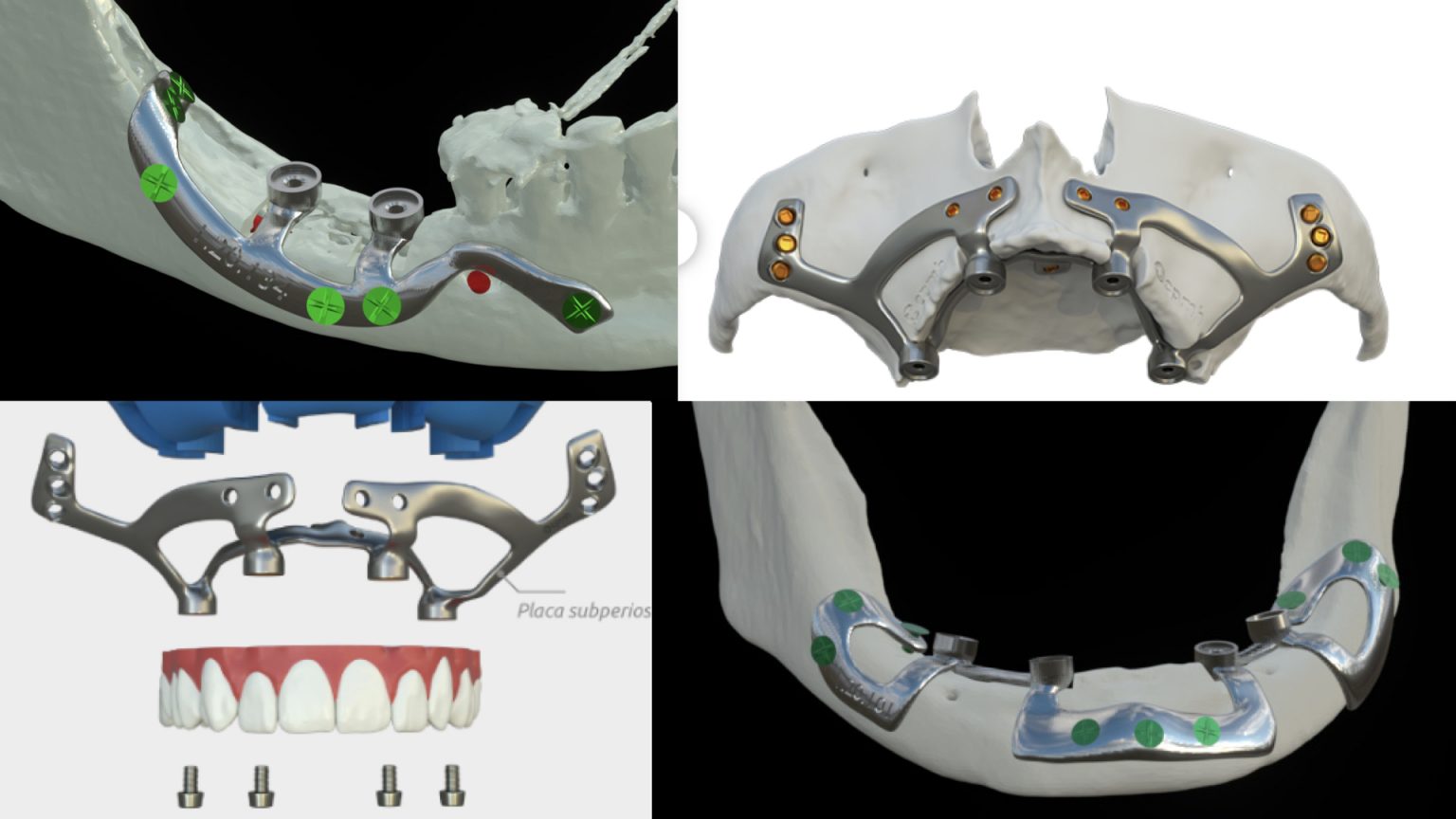 A New Full Arch Dental Implant Treatment For Patients with Complete ...