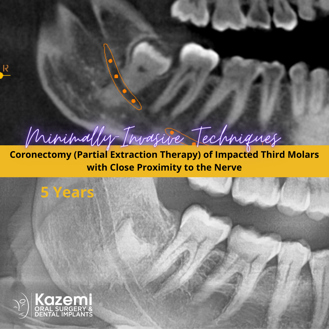 Impacted Wisdom Tooth Extraction