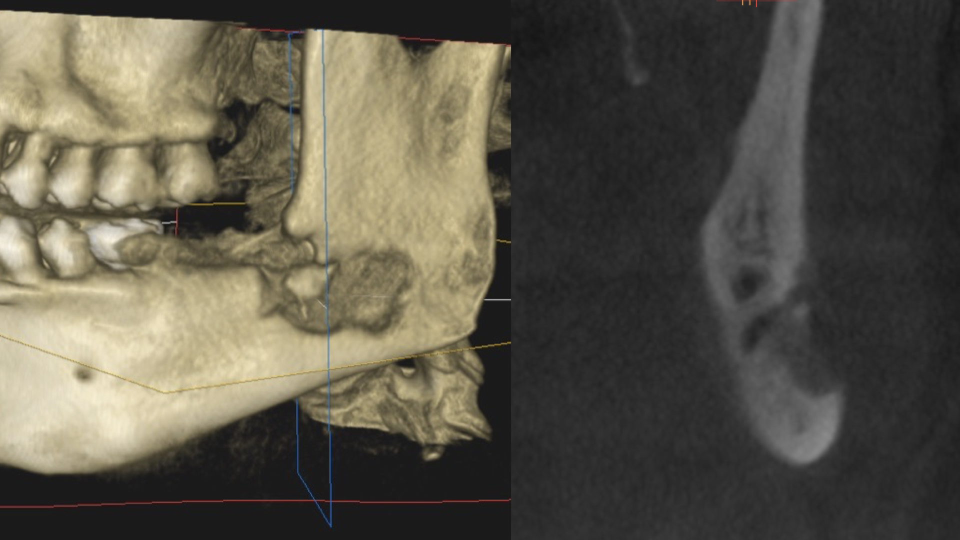 Osteomyelitis Pictures Osteomyelitis Pictures