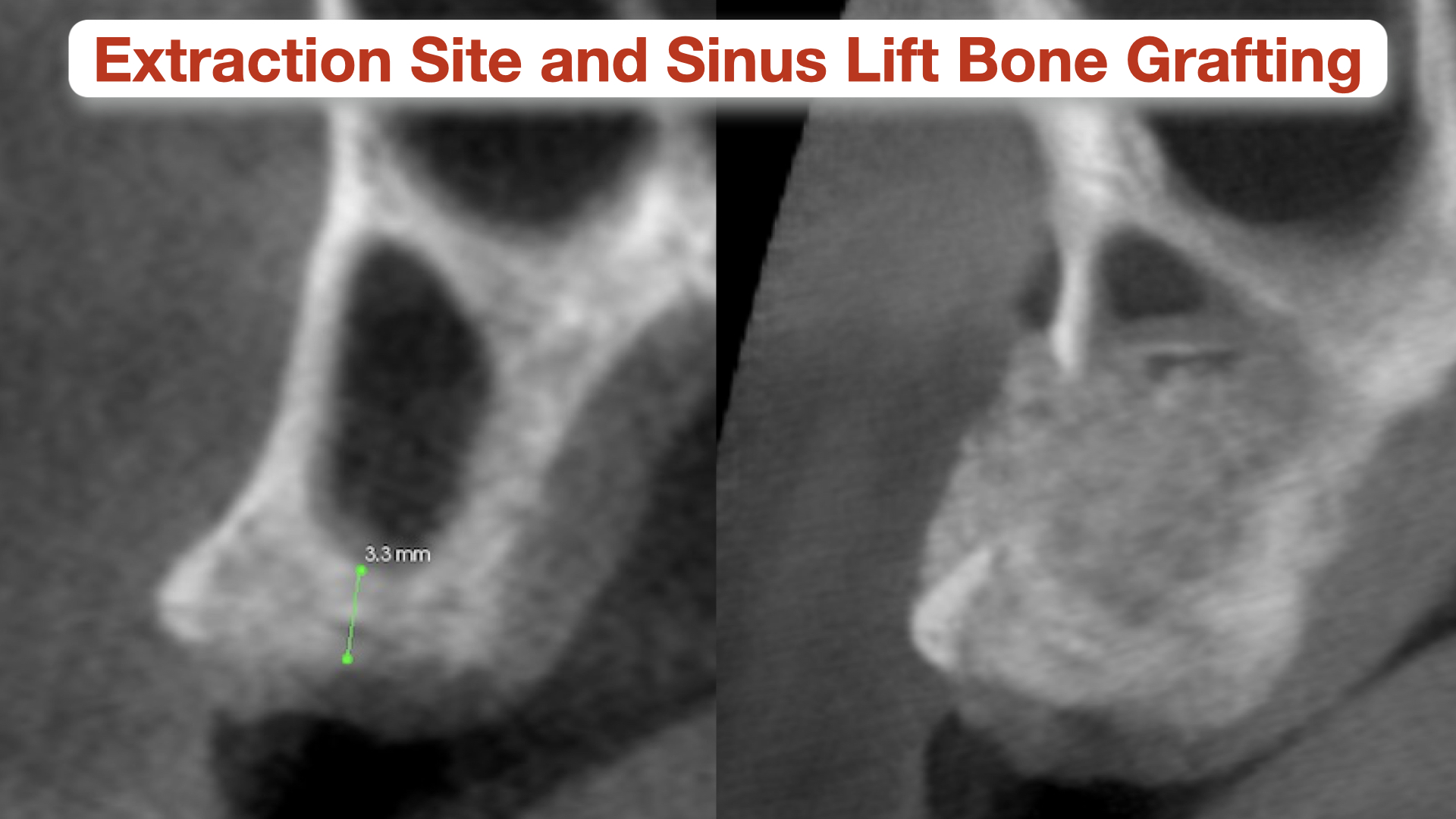 Staged Tooth Extraction & Site Bone Graft and Sinus Lift Bone Graft to ...