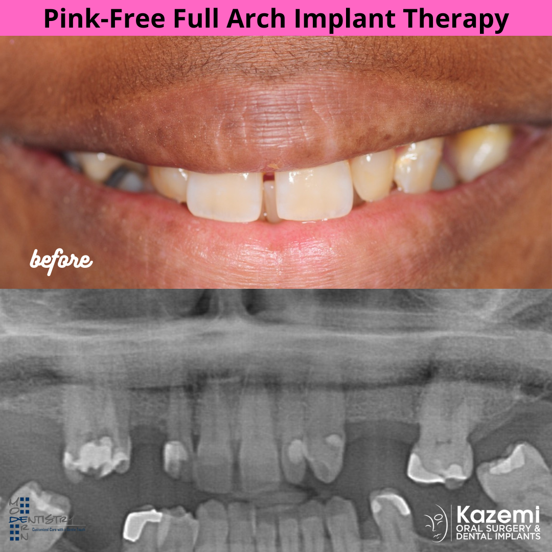 Replacement of Missing and Non-Treatable Teeth with Full Arch Dental ...