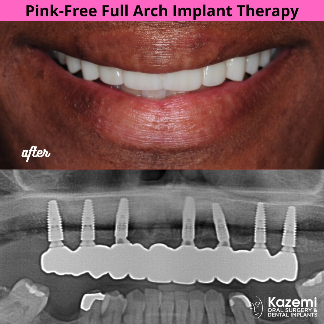 Replacement of Missing and Non-Treatable Teeth with Full Arch Dental ...