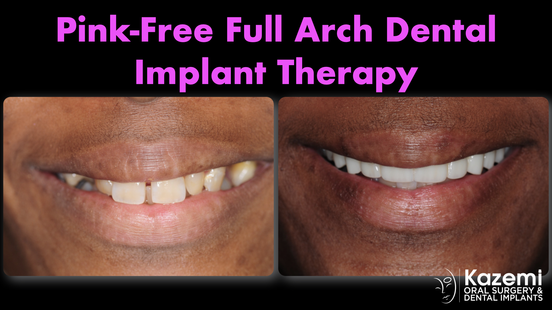 Pink-Free Full Arch Dental Implant Replacement of Upper Teeth | Pink ...