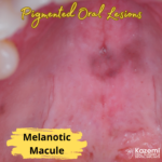 Pigmented (Purple or Brown) Lesions in the Mouth | Pigmented (Purple or ...