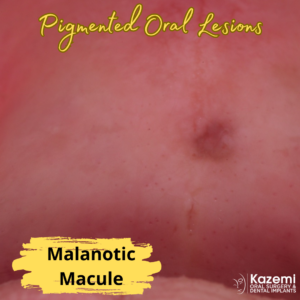 Pigmented (Purple or Brown) Lesions in the Mouth | Pigmented (Purple or ...