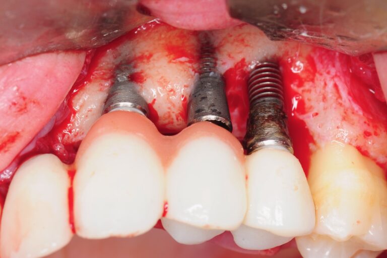 Swollen and Painful Gum Around Dental Implants | Swollen and Painful ...