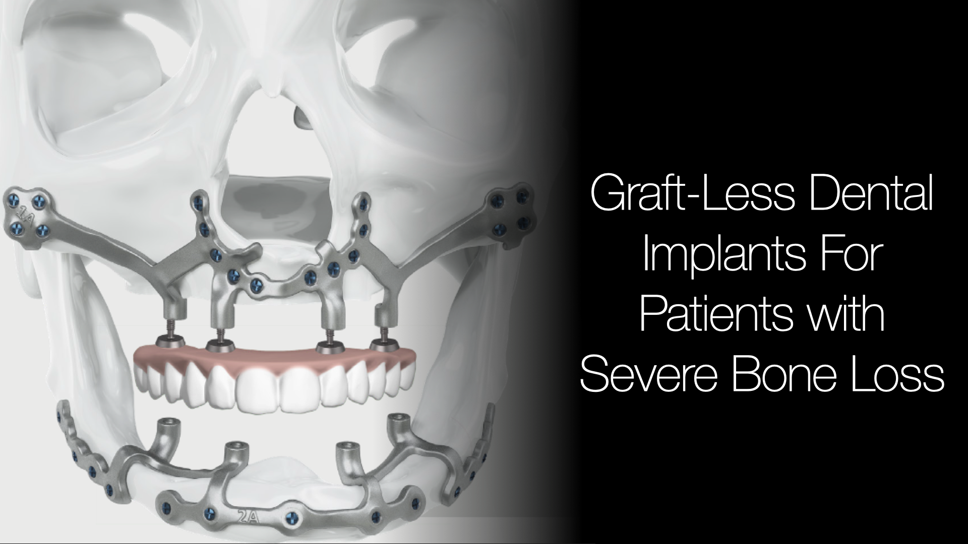 Dental Implants for Patients With No Bone : A New Graft-Less Solution ...