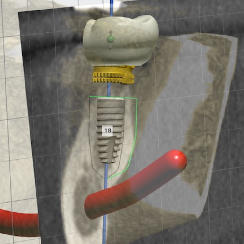 Why Every Dental Implant Case Is Digitally Planned and Guided at Our ...